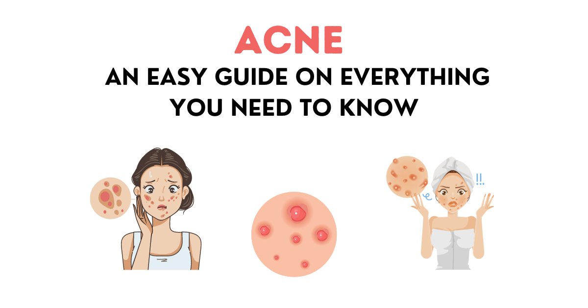 Acne : An Easy Guide on Everything You Need To Know